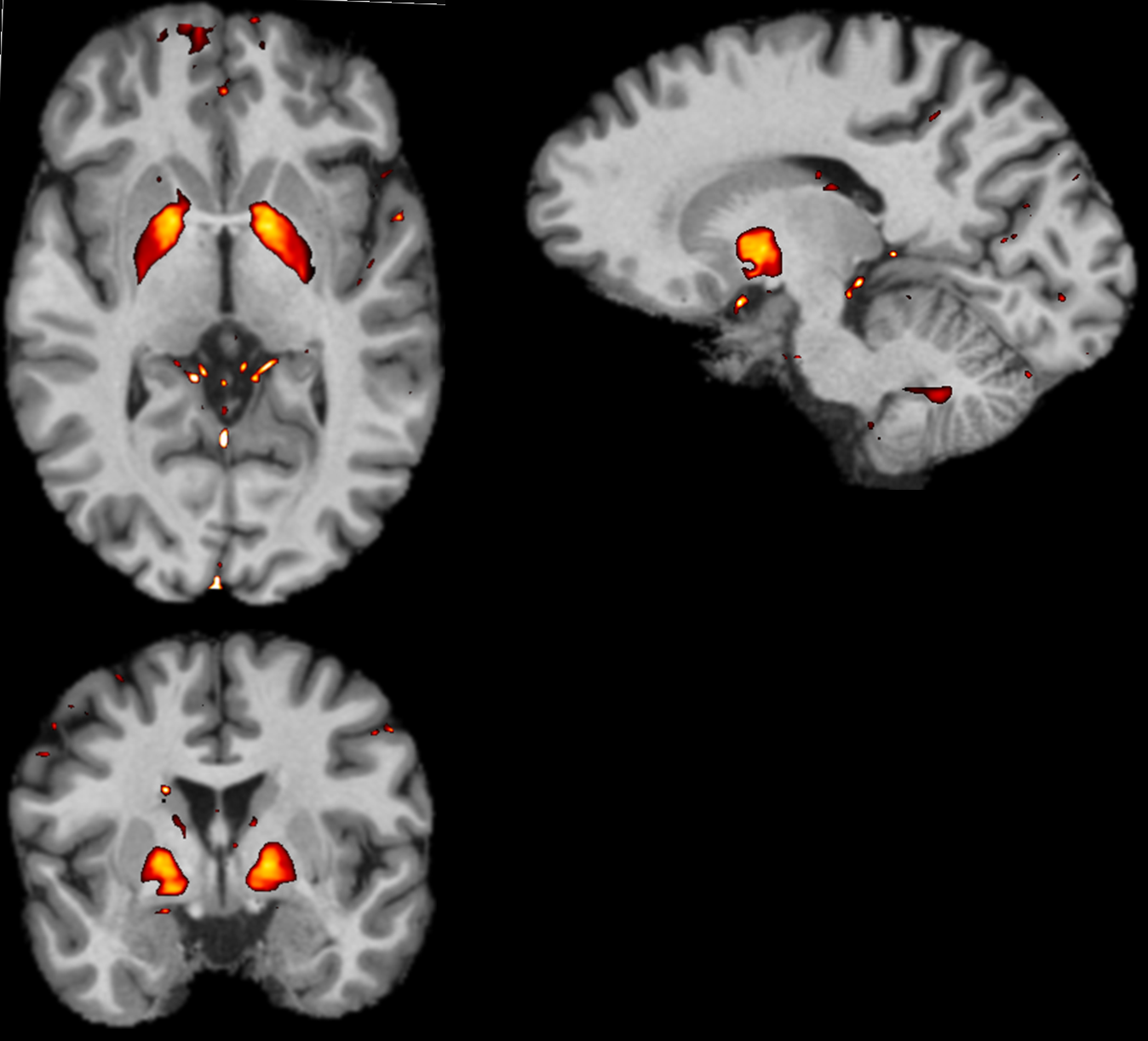 QSM Quantitative Susceptibility Mapping - Ventio